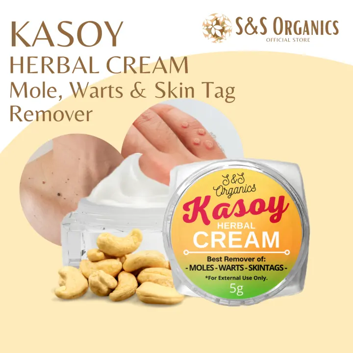 S&S Kasoy Warts Remover Original Cream for Skin Tag and Mole Removal ...
